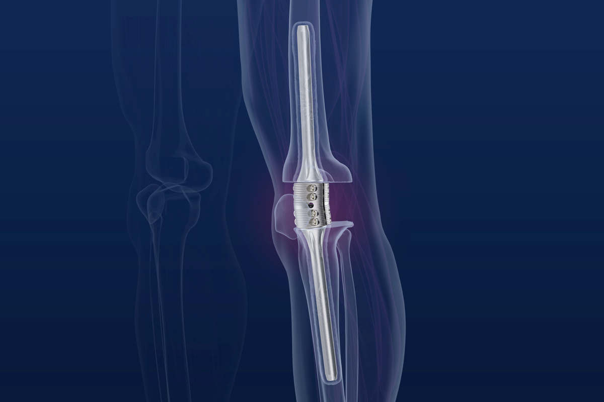 OsteoBridge™ Knee Arthrodesis – Standard System – Merete GmbH